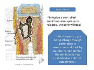 PATHOPHYSIOLOGY OF SEQUESTRUM.pptx