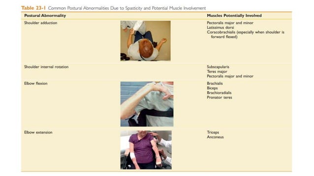 PATHOPHYSIOLOGY OF SPASTICITY.pptx