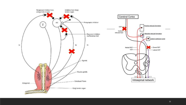 Pathophysiology of Spasticity | PPTX