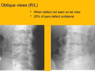 Pathophysiology of Spondylolisthesis.pptx