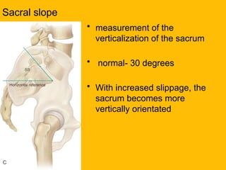 Pathophysiology of Spondylolisthesis.pptx