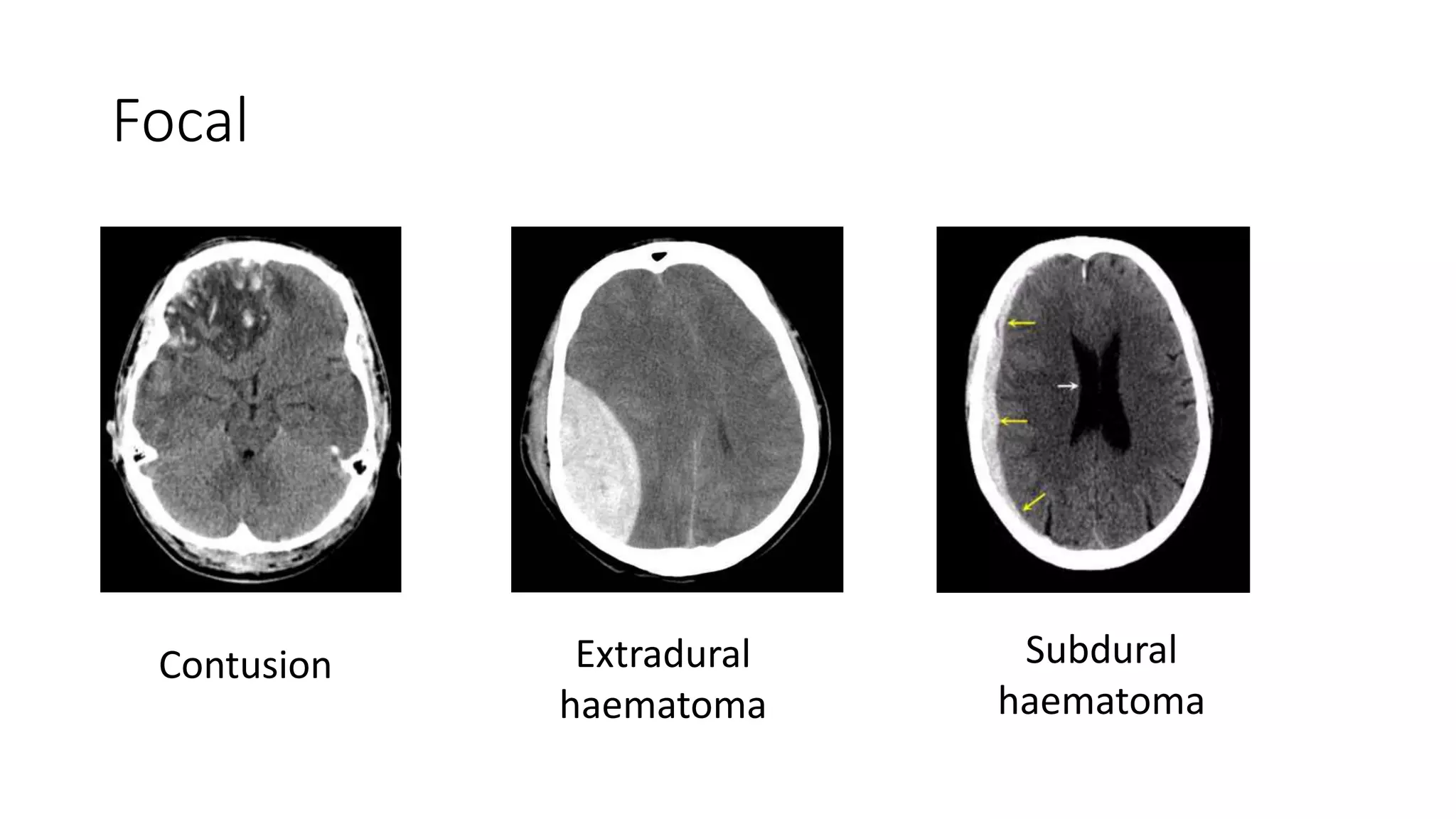 Traumatic Brain Injury (TBI) | PPTX