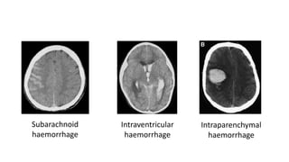 Traumatic Brain Injury (TBI) | PPTX