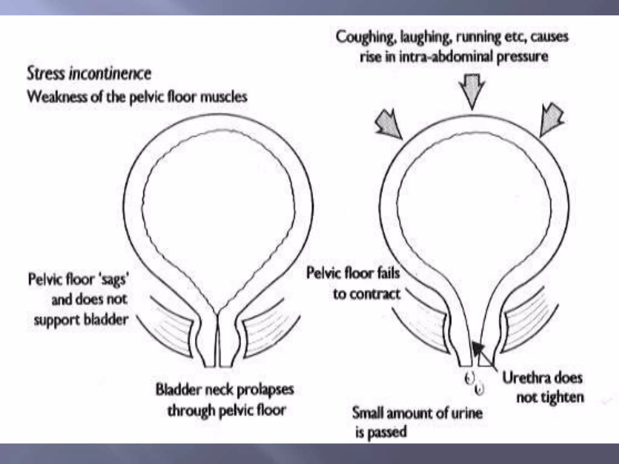 Pathophysiology of urinary incontinence | PPTX