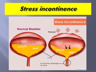 Pathophysiology of urinary incontinence | PPTX