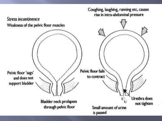 Pathophysiology of urinary incontinence | PPTX