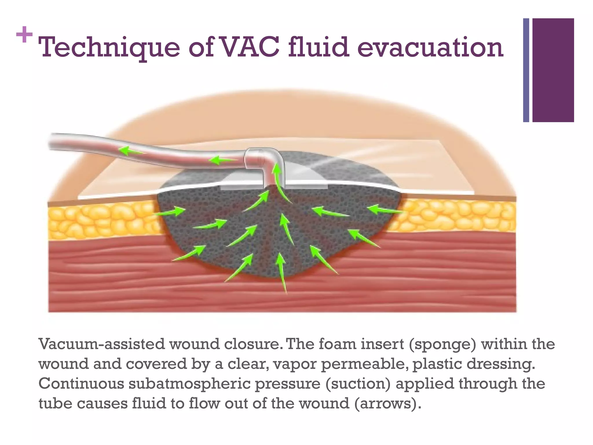Pathophysiology of wound healing | PPT