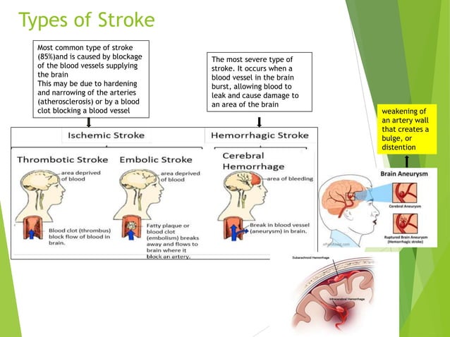 Pathophysiology stroke | PPT