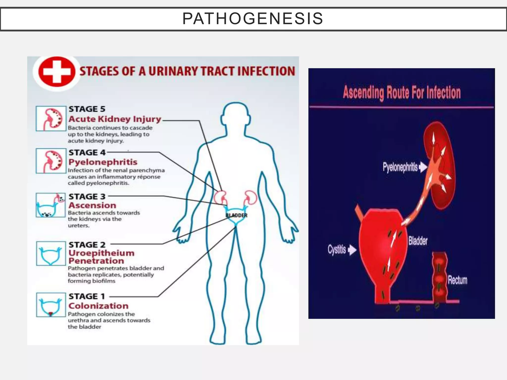 Pathophysiology urinary tract infections | PPTX