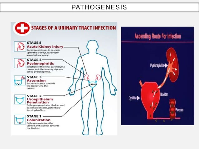 Pathophysiology urinary tract infections | PPTX | Infectious Diseases ...