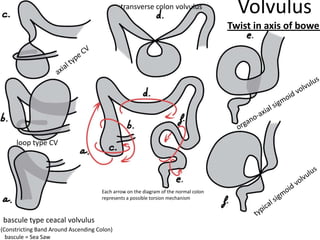 Pathopyshiology of Intestinal Obstruction CHIRANTAN MANDAL Medical ...
