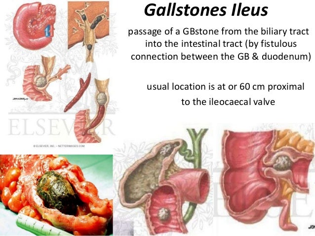 Pathopyshiology of Intestinal Obstruction CHIRANTAN MANDAL Medical Co…