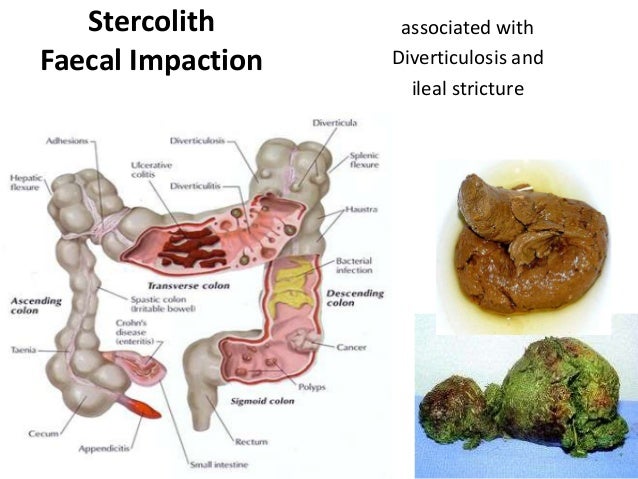 Pathopyshiology of Intestinal Obstruction CHIRANTAN MANDAL Medical Co…