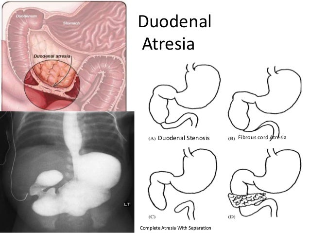 Pathopyshiology of Intestinal Obstruction CHIRANTAN MANDAL Medical Co…
