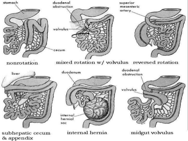 Pathopyshiology of Intestinal Obstruction CHIRANTAN MANDAL Medical Co…