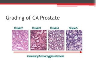 Grading and staging of tumors and paraneoplastic syndrome | PPT