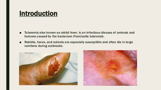 Tularemia Disease