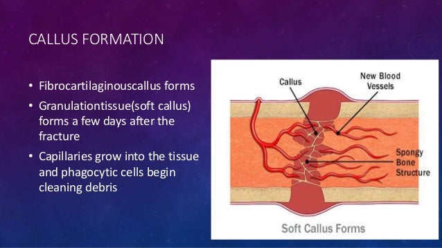 Pathphysiology of fracture healing and repair