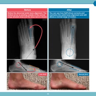 Patient's Guide to HyProCure - Minimally Invasive Solution to ...