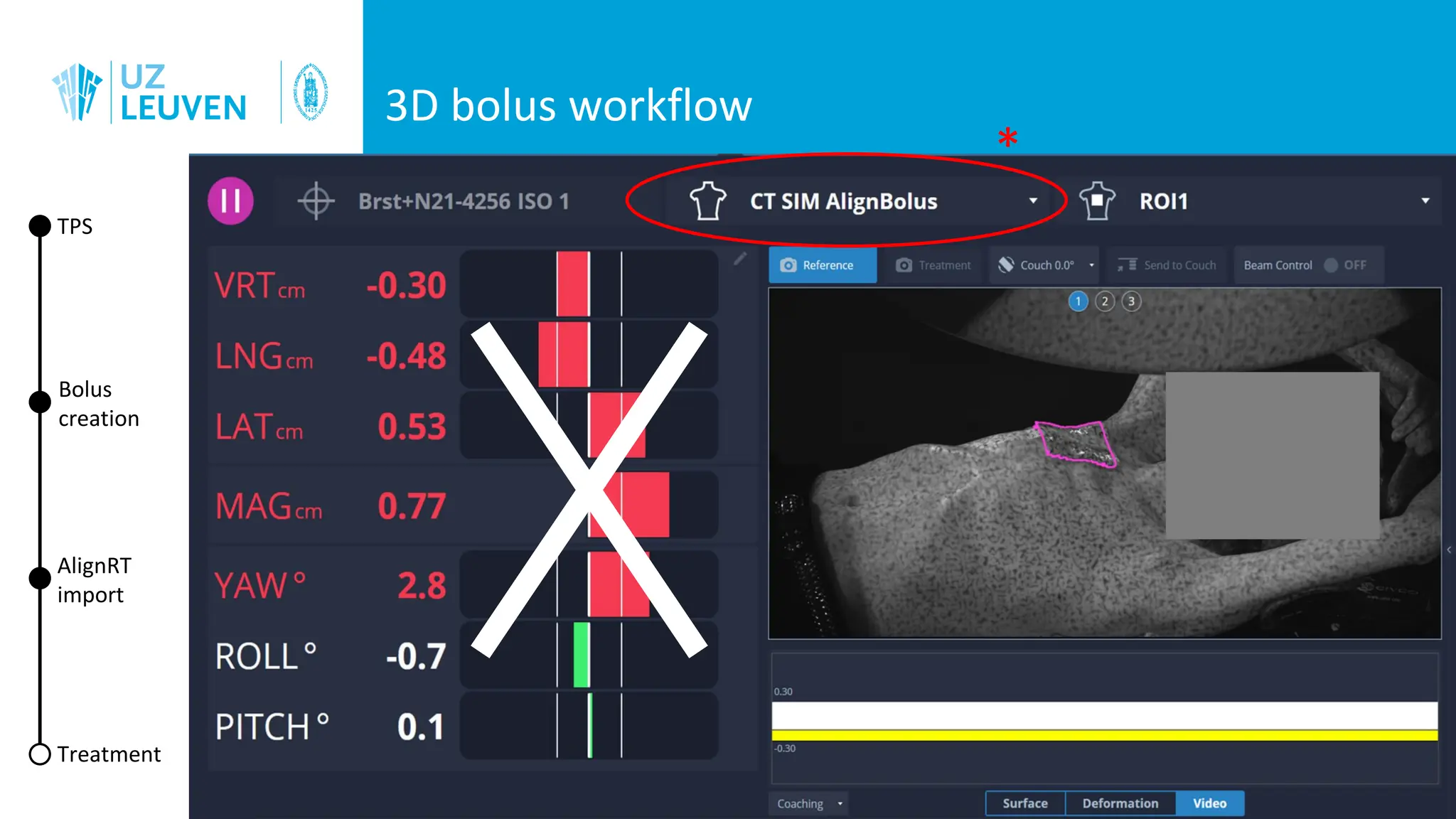 Patient-specific bolus positioning with AlignRT | PDF