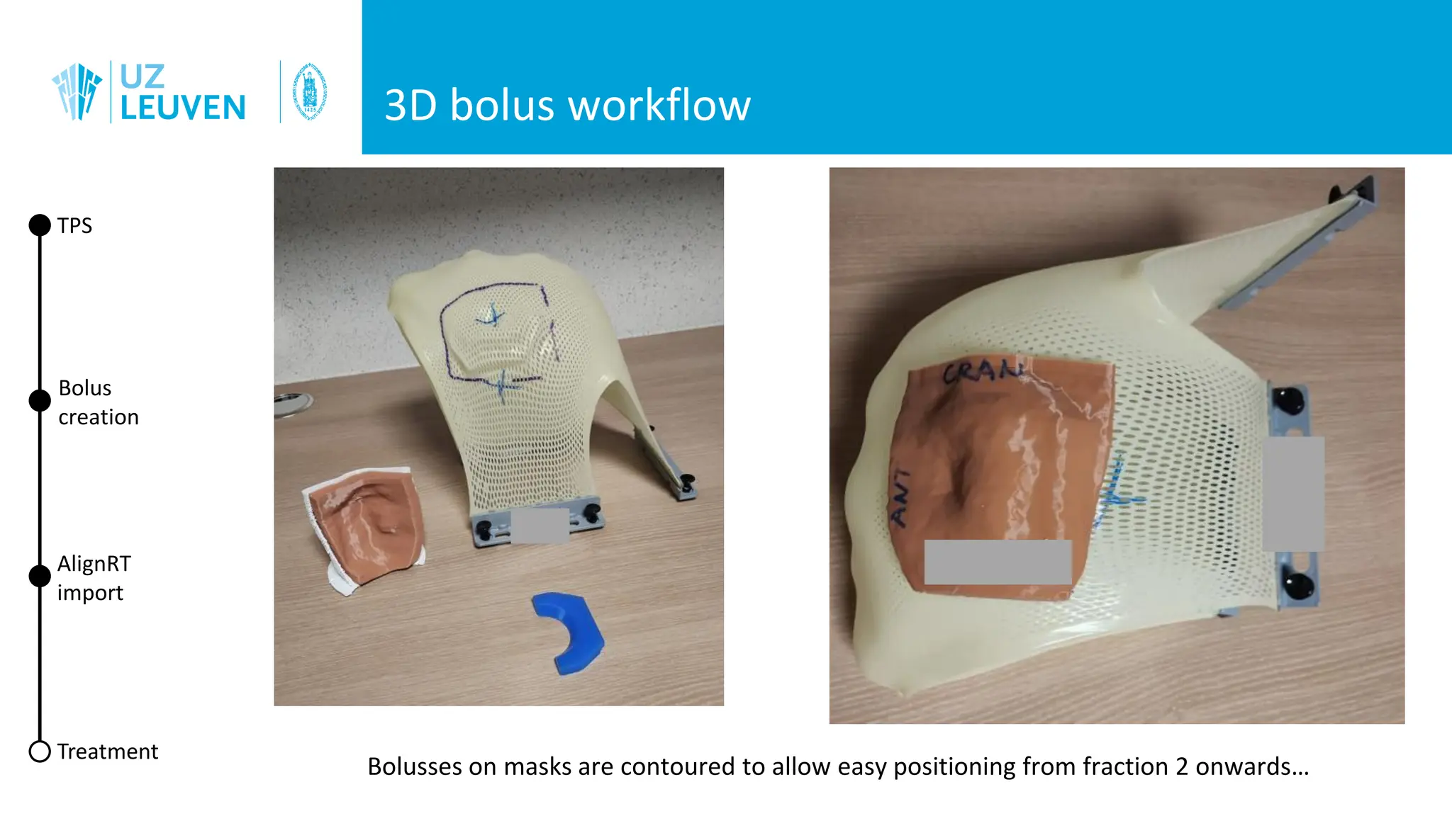 Patient-specific bolus positioning with AlignRT | PDF