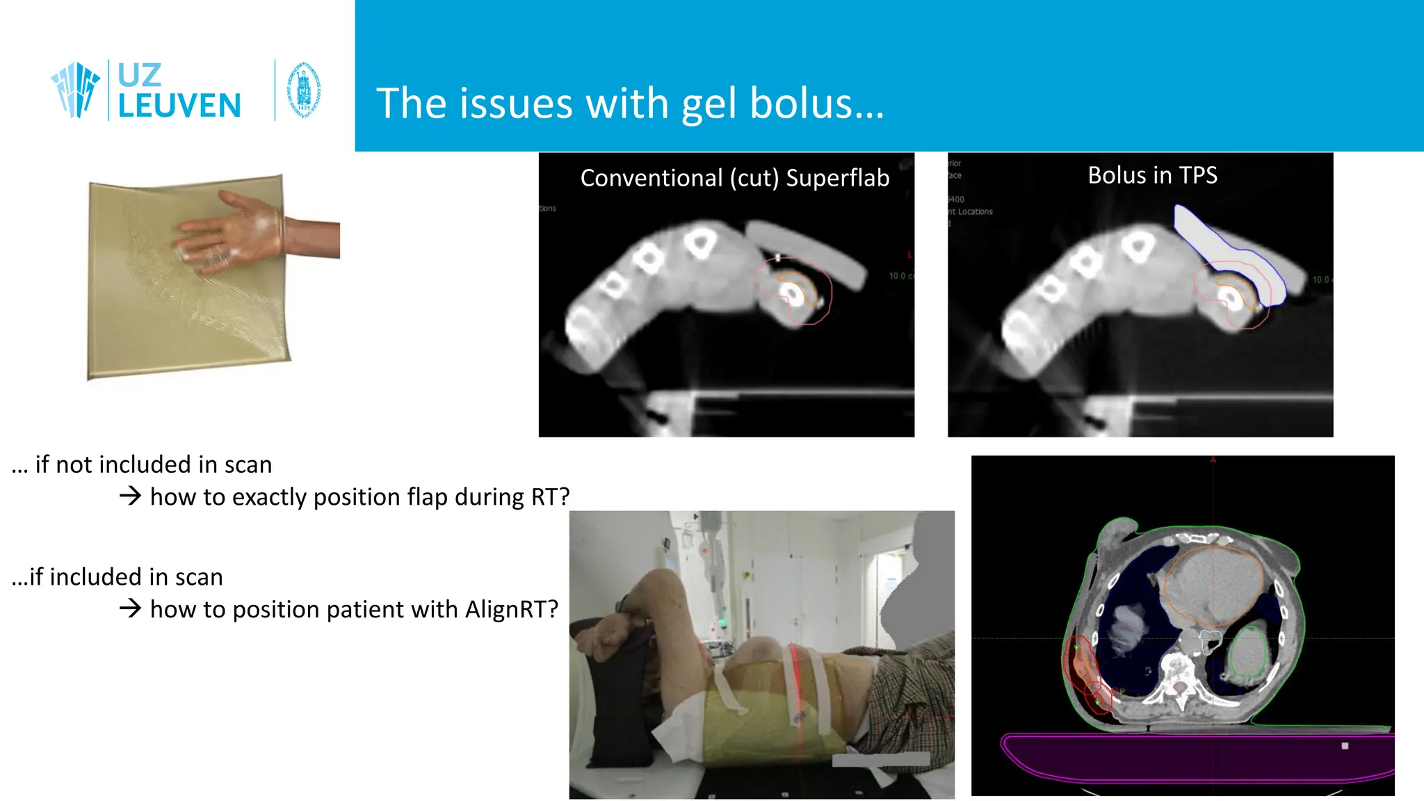 Patient-specific bolus positioning with AlignRT | PDF