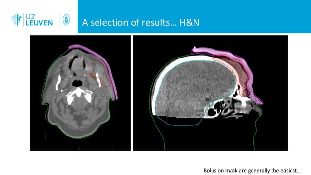 Patient-specific bolus positioning with AlignRT | PDF | Medical Health