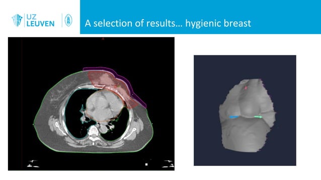 Patient-specific bolus positioning with AlignRT | PDF | Medical Health