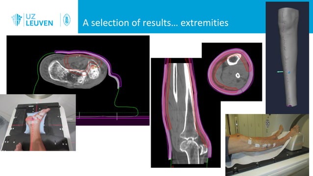 Patient-specific bolus positioning with AlignRT | PDF | Medical Health