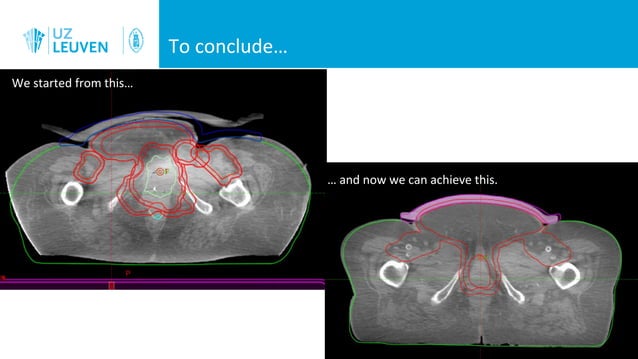 Patient-specific bolus positioning with AlignRT | PDF | Medical Health