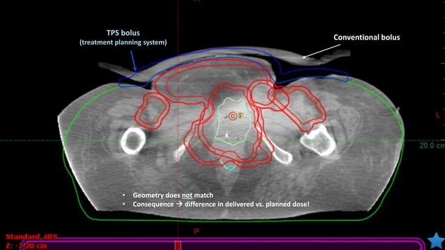 Patient-specific bolus positioning with AlignRT | PDF | Medical Health