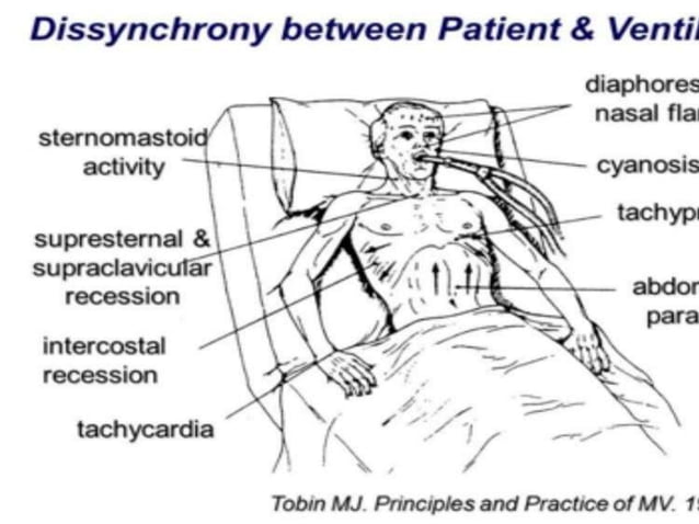 Patient-ventilator dyssynchrony.pptx
