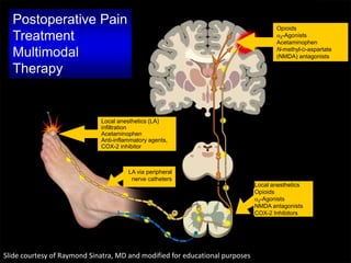 Patient controlled analgesia(pca) | PPTX