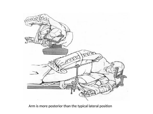 Patient Positioning.ppt in neurosurgery operations in theatre | PPT