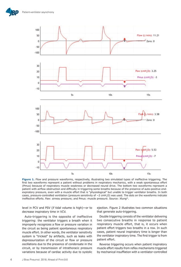 Patient Ventilator Asynchrony Jbp Review Pdf