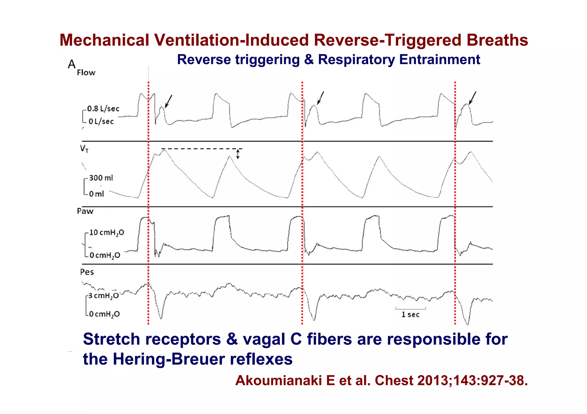 Patient ventilator interactions during mechanical ventilation | PDF