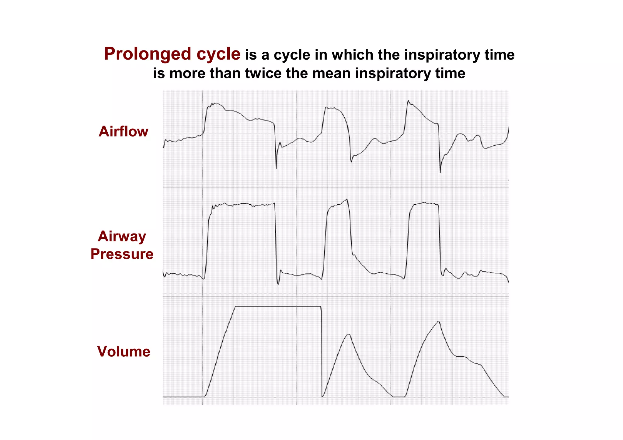 Patient ventilator interactions during mechanical ventilation | PDF