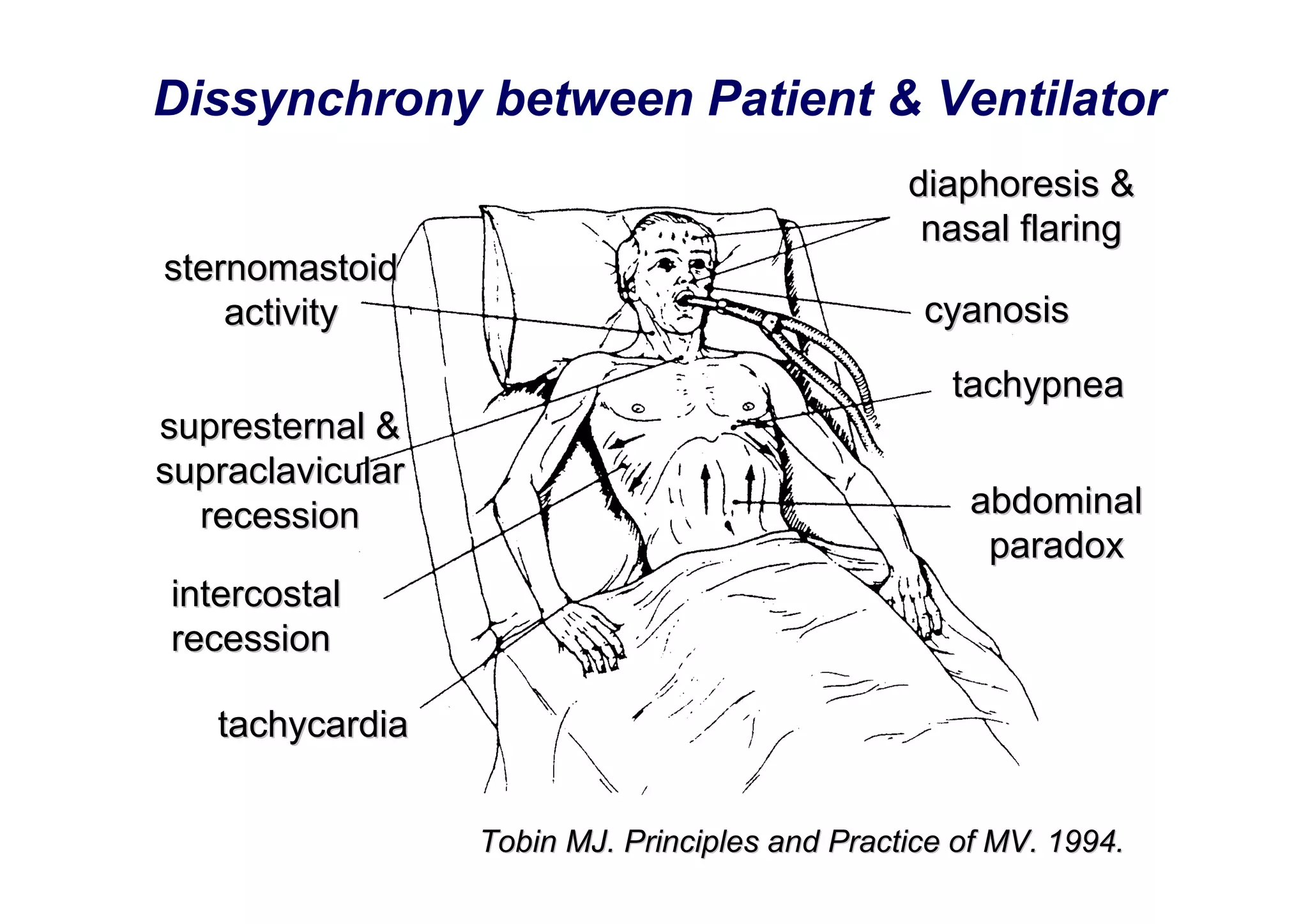 Patient ventilator interactions during mechanical ventilation | PDF
