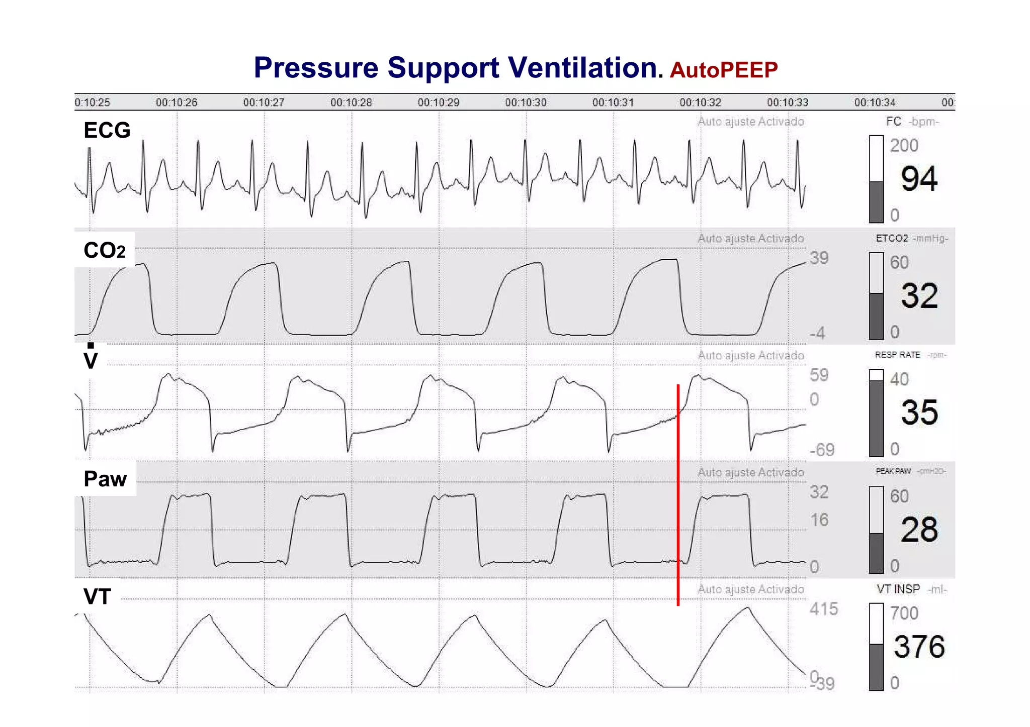 Patient ventilator interactions during mechanical ventilation | PDF