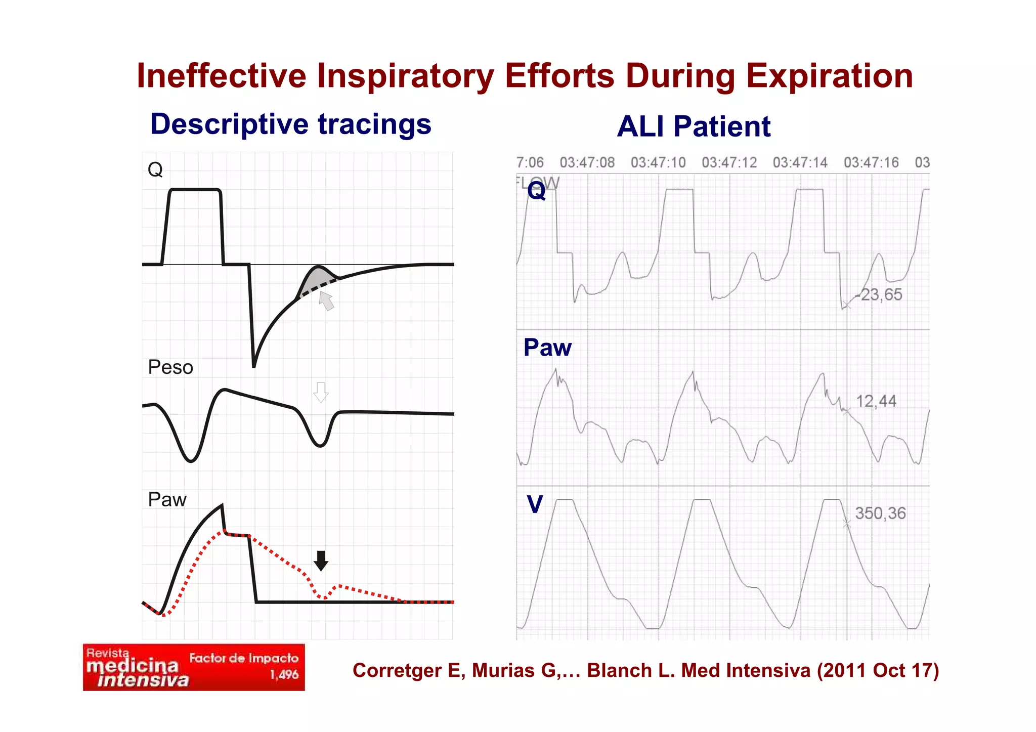 Patient ventilator interactions during mechanical ventilation | PDF