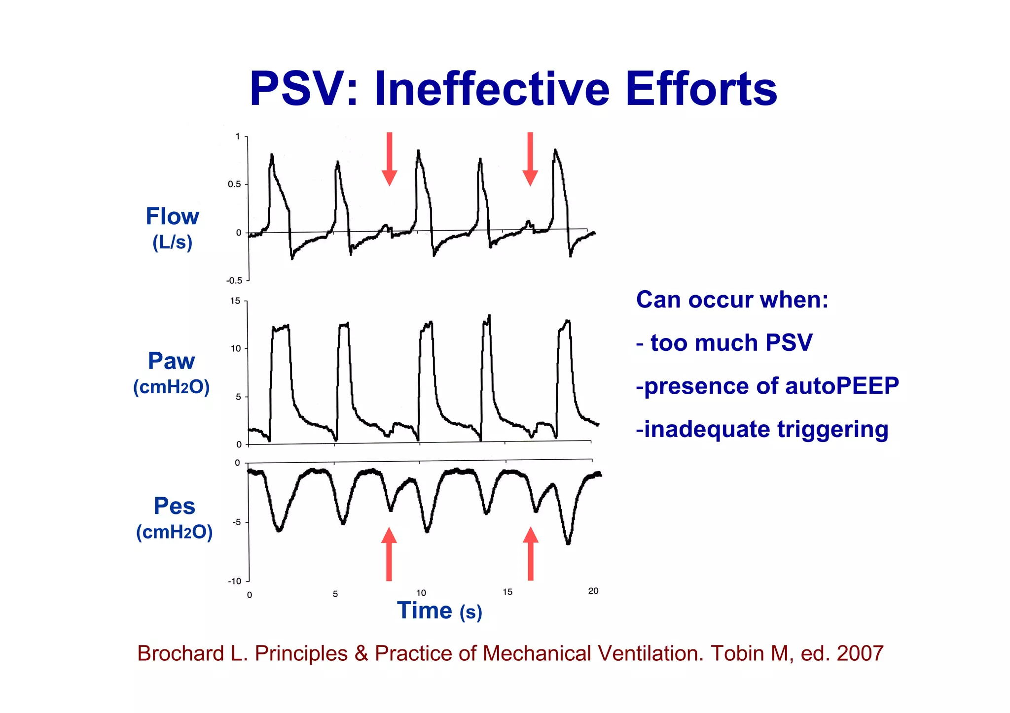 Patient ventilator interactions during mechanical ventilation | PDF