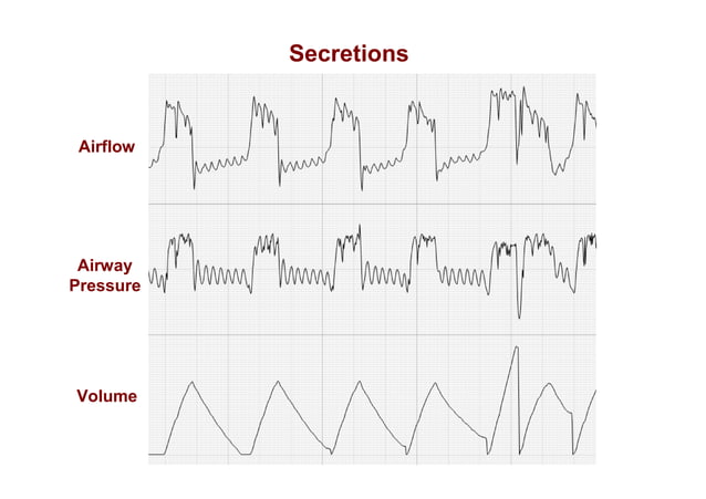 Patient ventilator interactions during mechanical ventilation | PDF