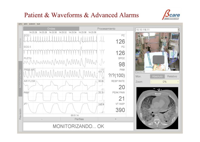 Patient ventilator interactions during mechanical ventilation | PDF
