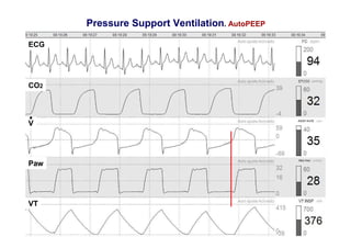 Patient ventilator interactions during mechanical ventilation | PDF