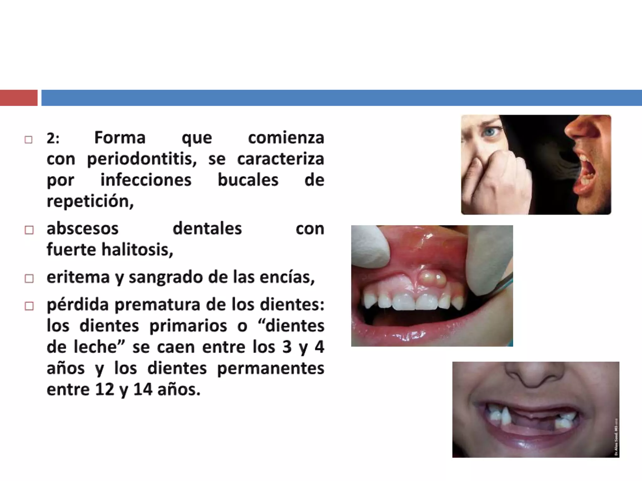 Síndrome de papillon lefevre | PPT