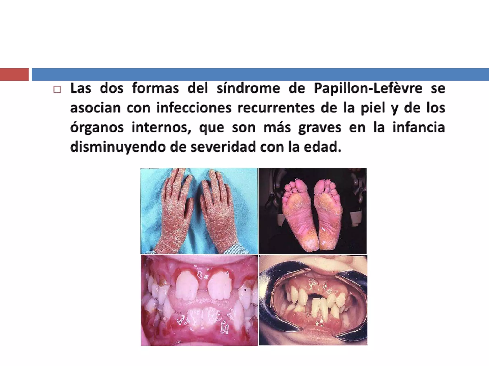 Síndrome de papillon lefevre | PPT