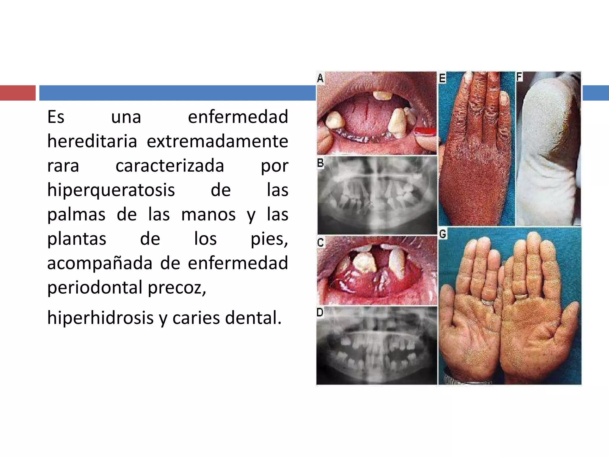 Síndrome de papillon lefevre | PPT