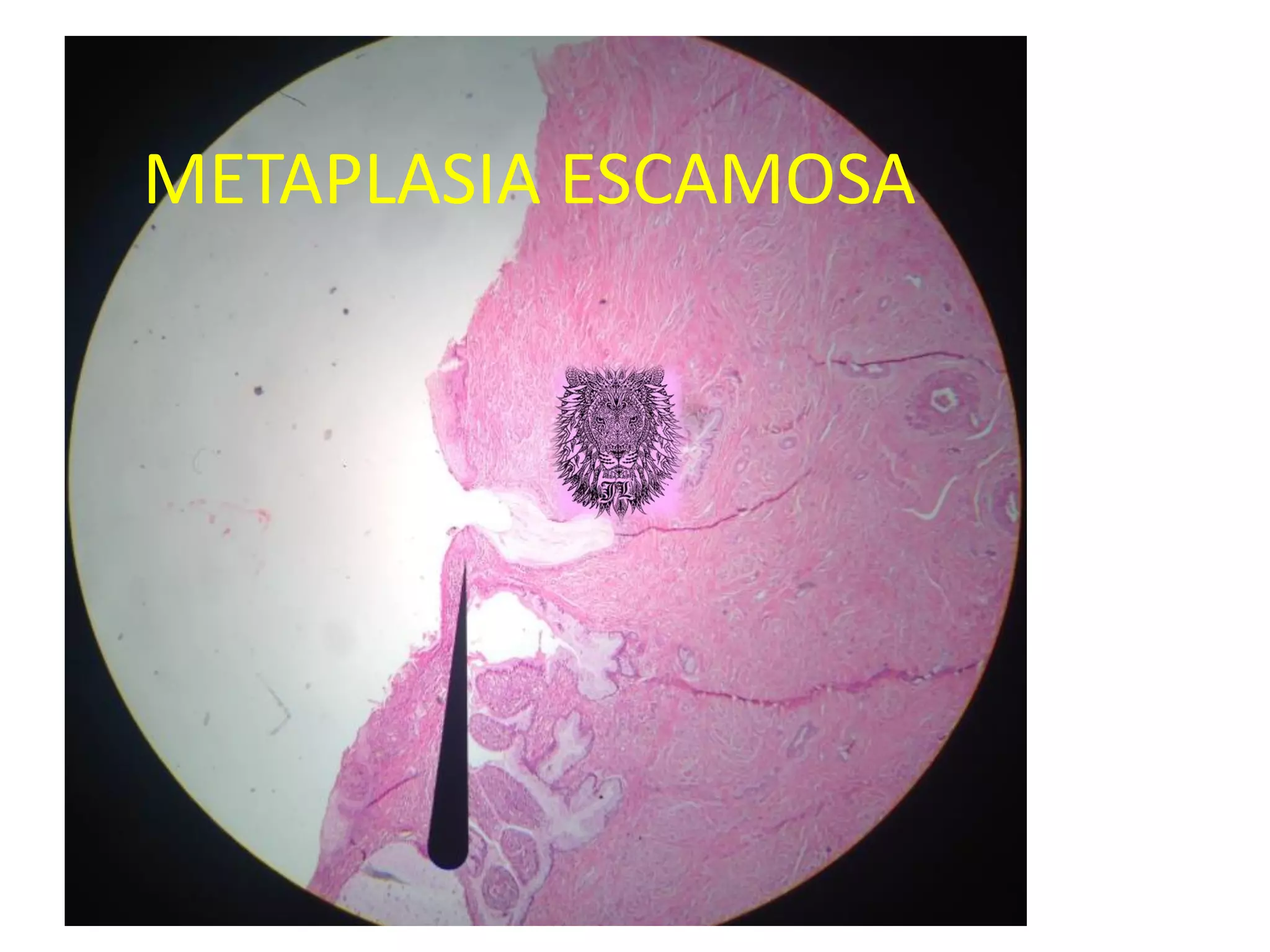 PATOLOGIA ATROFIA TESTICULAR, METAPLASIA ESCAMOSA, DISPLASIA UTERINA ...