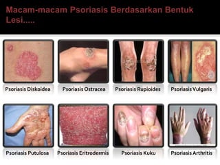 PSORIASIS | PPTX