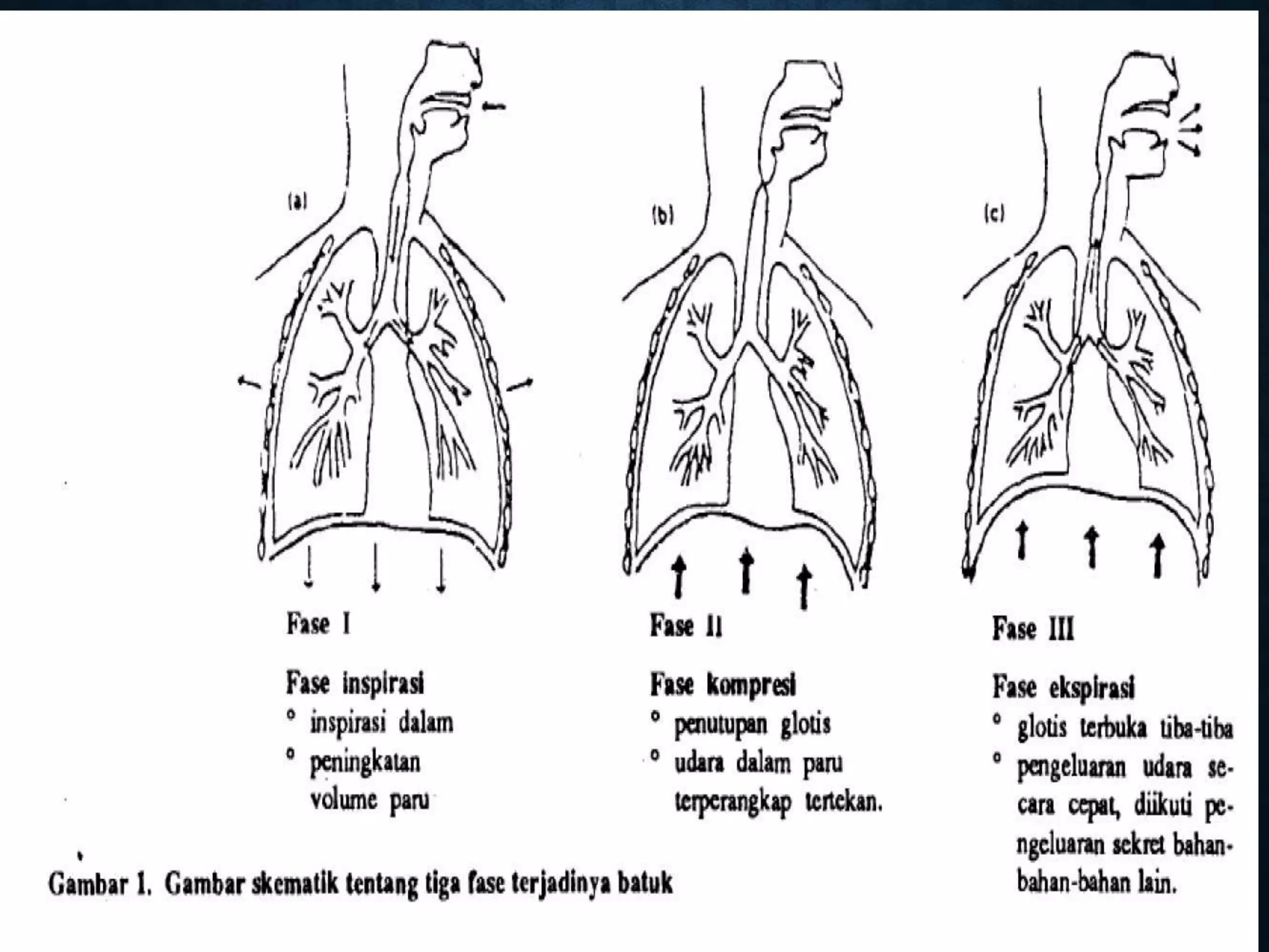 Patofisiologi batuk | PPTX
